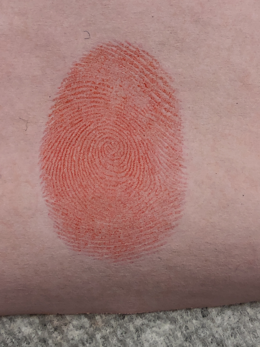 Oil Red O Lipid Stain – medtechforensics